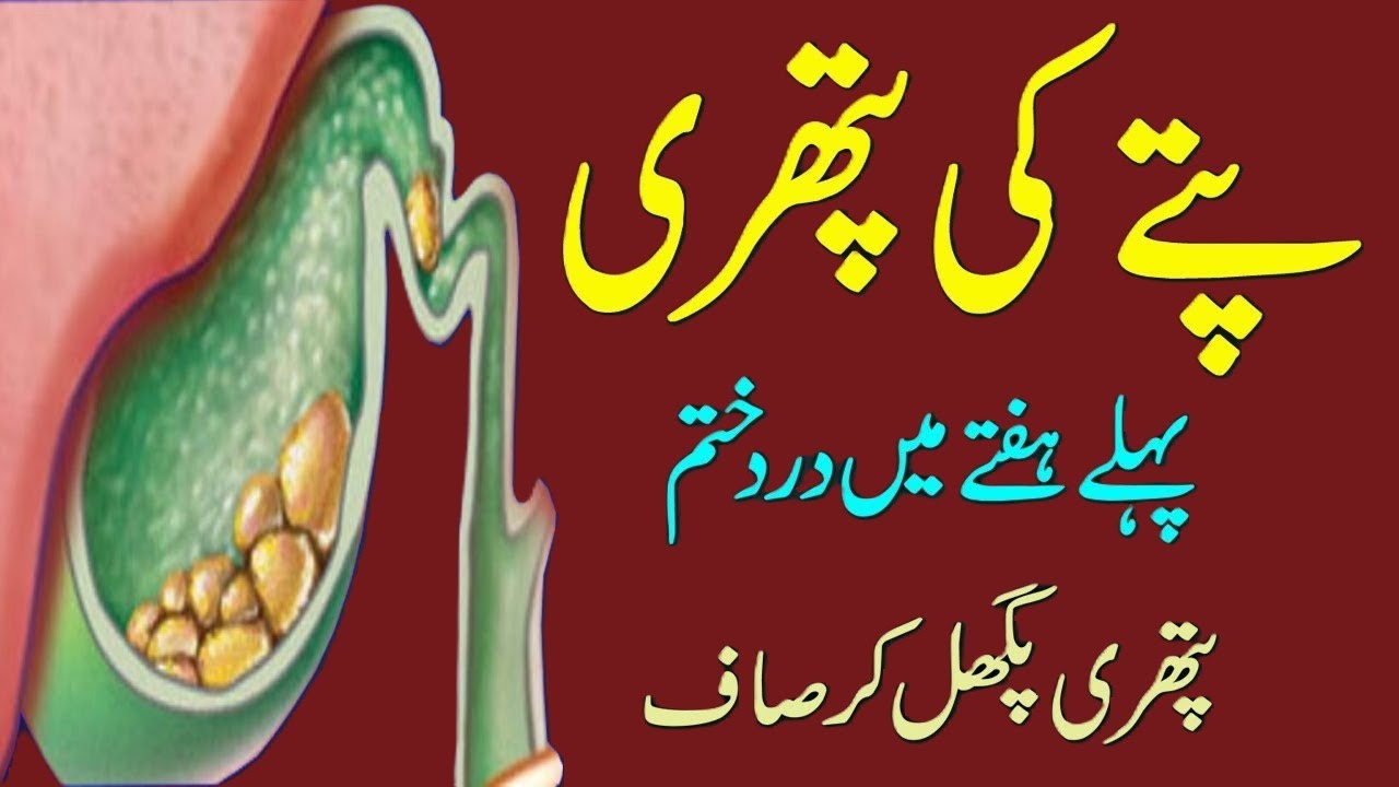 Pitay ki pathri ka ilaj#Pitay ka dard say jan kasy chadwayien#Pitay ki ...