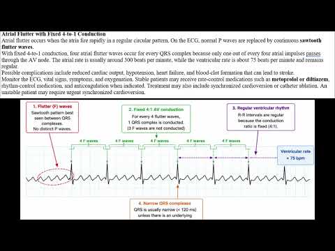 Atrial flatter 4 :1 fixed ECG