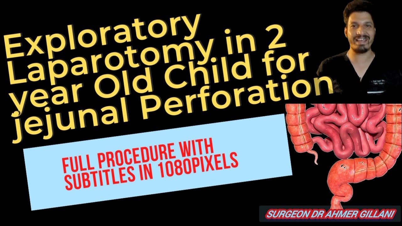 Exploratory Laparotomy in Child For jejunal Perforation/Complete ...
