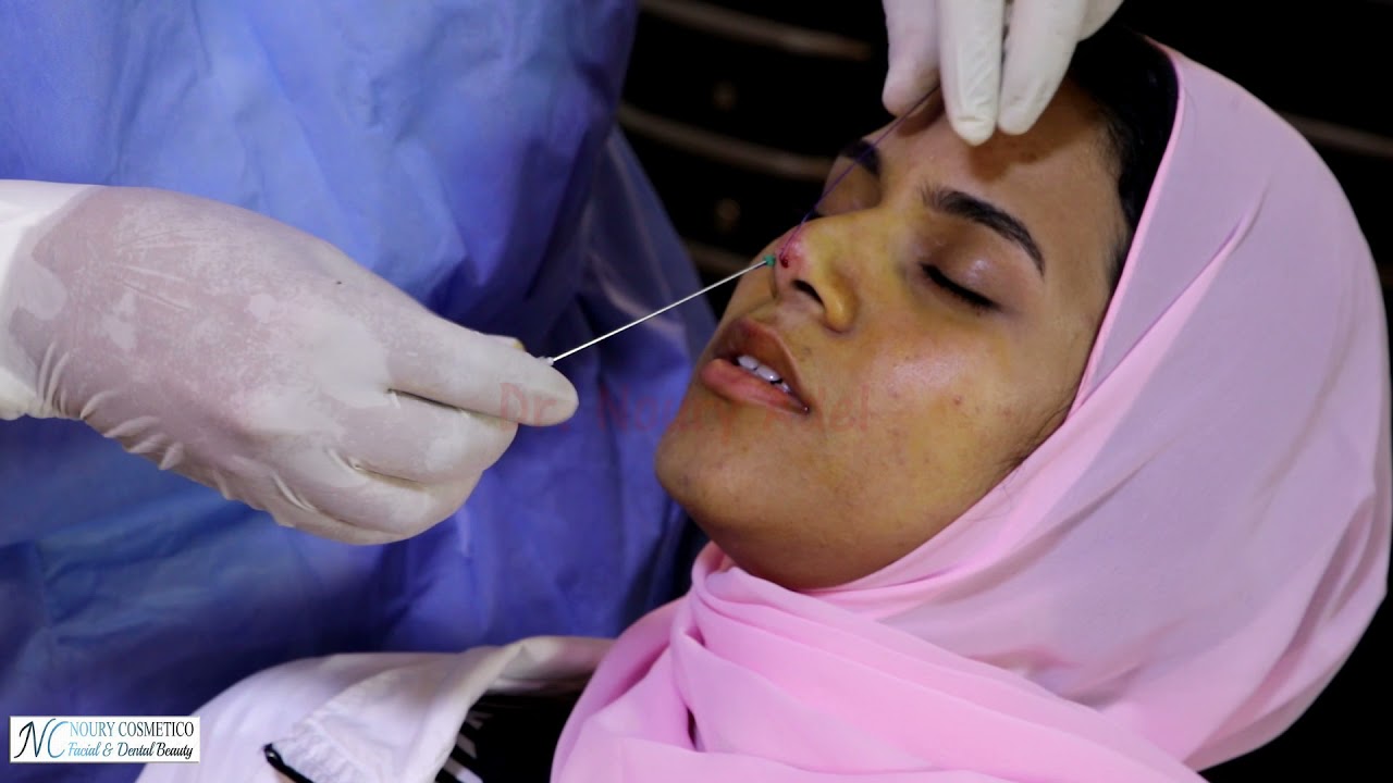 Nose threads ( Non surgical nose job using pdo threads ) - Dr. Noury ...