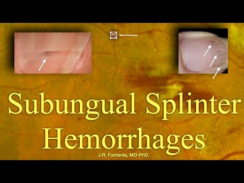Splinter Hemorrhages Endocarditis