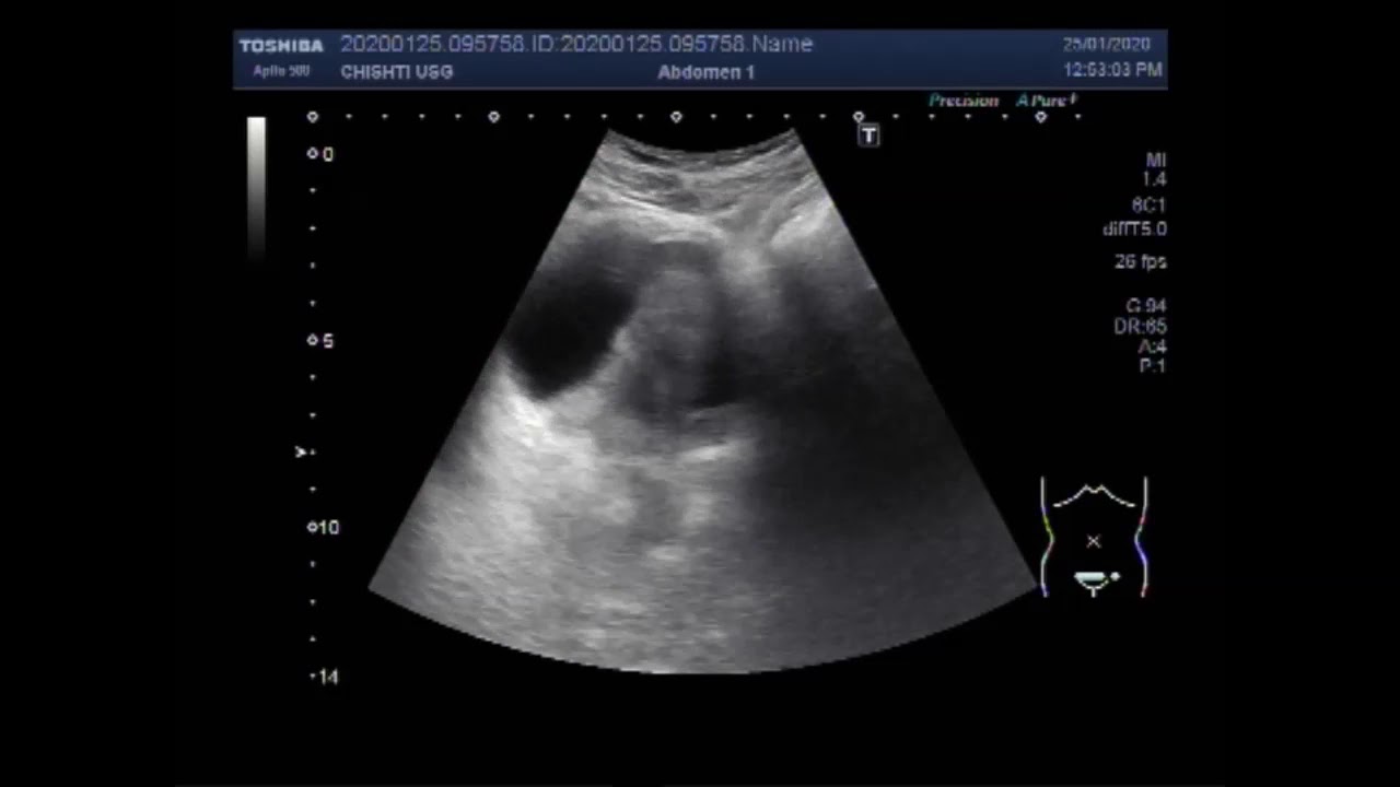 Ultrasound Video showing Enlarged Prostate, Prostatic mass, and stones ...