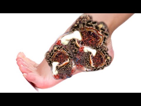 Surgeon Simulator 2 -ASMR Removes Large Pustules & Parasitic Maggots on ...