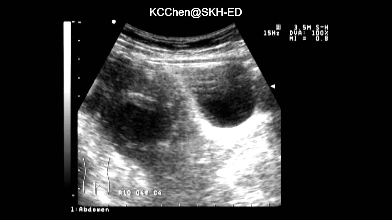 Right TOA and Pyosalpinx - YouTube