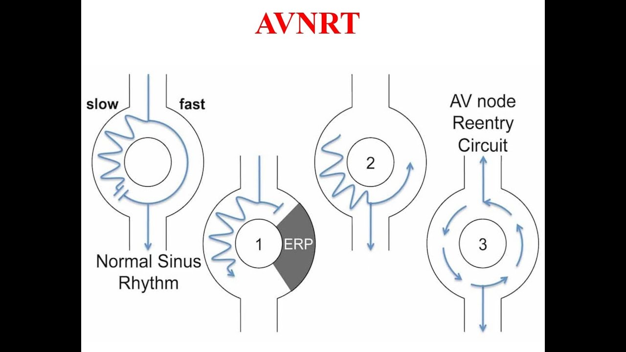 mechanism of ( AVNRT ) - YouTube