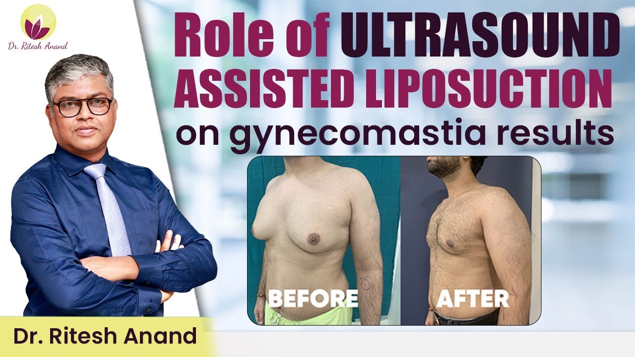 Gynecomastia Surgery Best Techniques | Liposuction Risks and Side ...