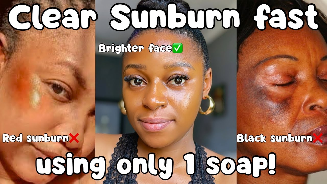 Best brightening face soaps for clearing SUNBURN How to get rid of ...