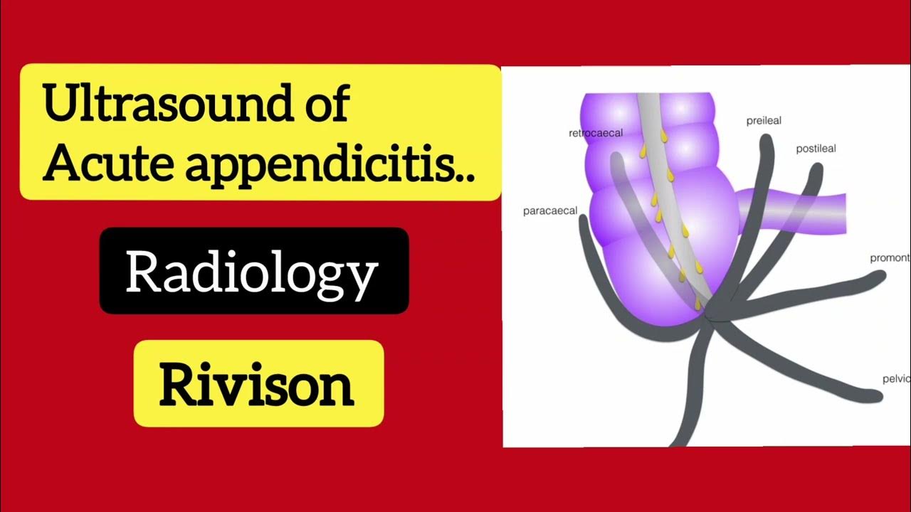 Ultrasound Of Acute Appendicitis Radiology Youtube
