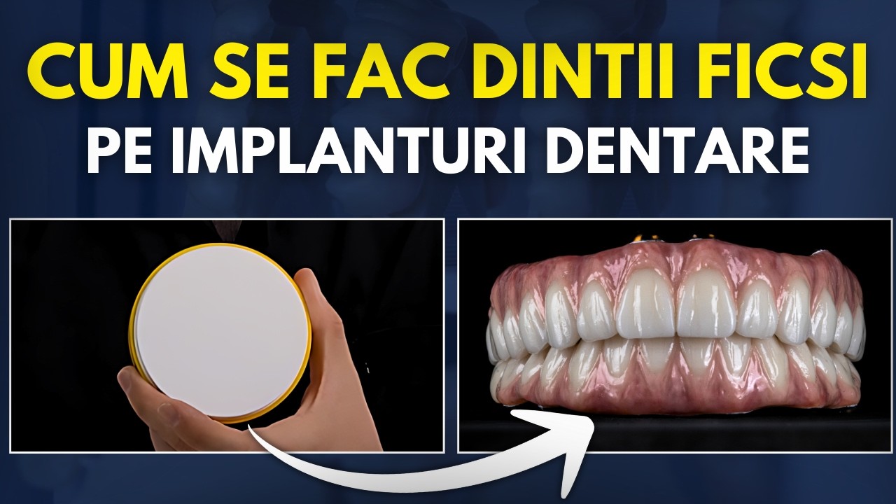Cum se fac Dintii Ficsi pe Implanturi - TOT PROCESUL - YouTube