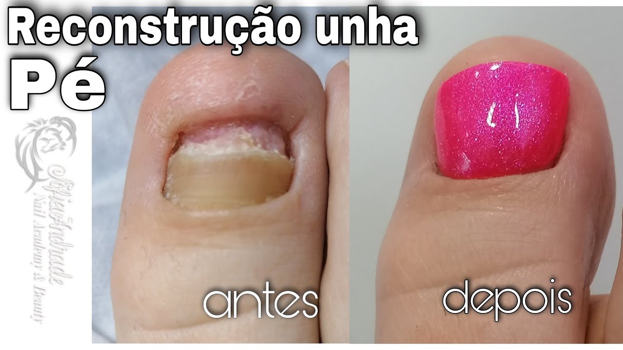 Como reconstruir unha do pé após tratamentos oncológicos - YouTube