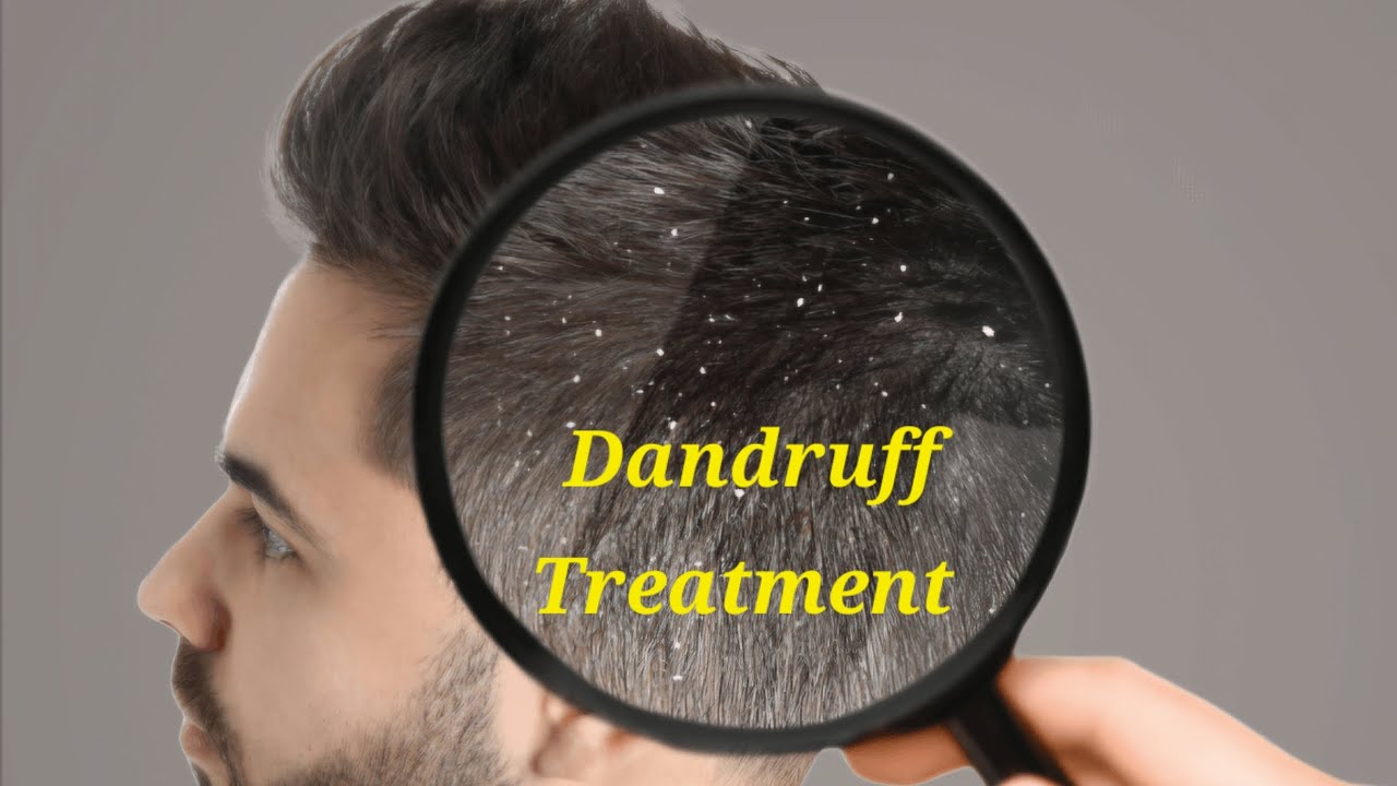 How to stop Dandruff - explained by Dr.Rashetha - YouTube