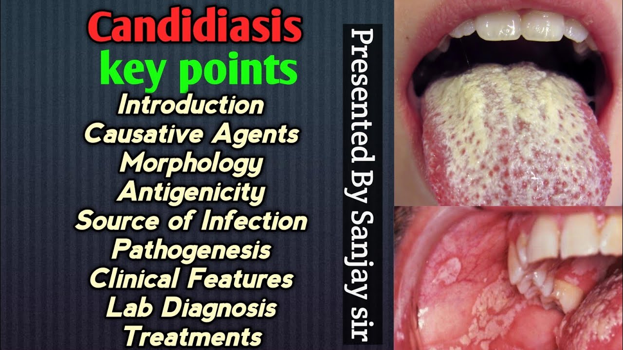 Candidiasis l Candida albicans l Opportunistic fungus l Morphology l ...