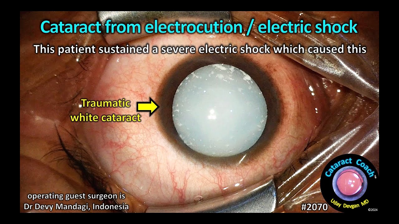CataractCoach™ 2070: cataract from electrocution / electric shock - YouTube