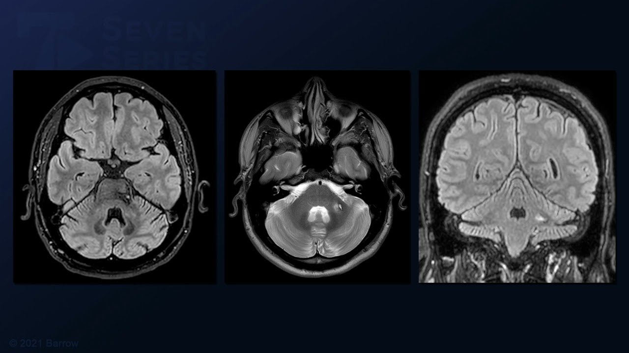 Microsurgical Resection of a Lateral Pontine AVM Masquerading as a ...