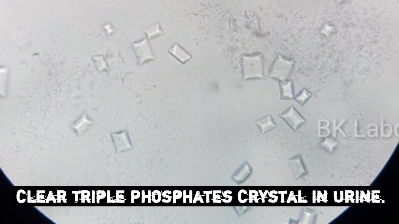 Clear Triple Phosphates Crystal in Urine - YouTube