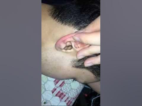 [Korean ear cleaning] Another huge ear wax! - YouTube