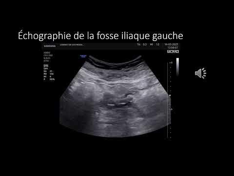 Echographie digestive. Syndrome occlusif - YouTube