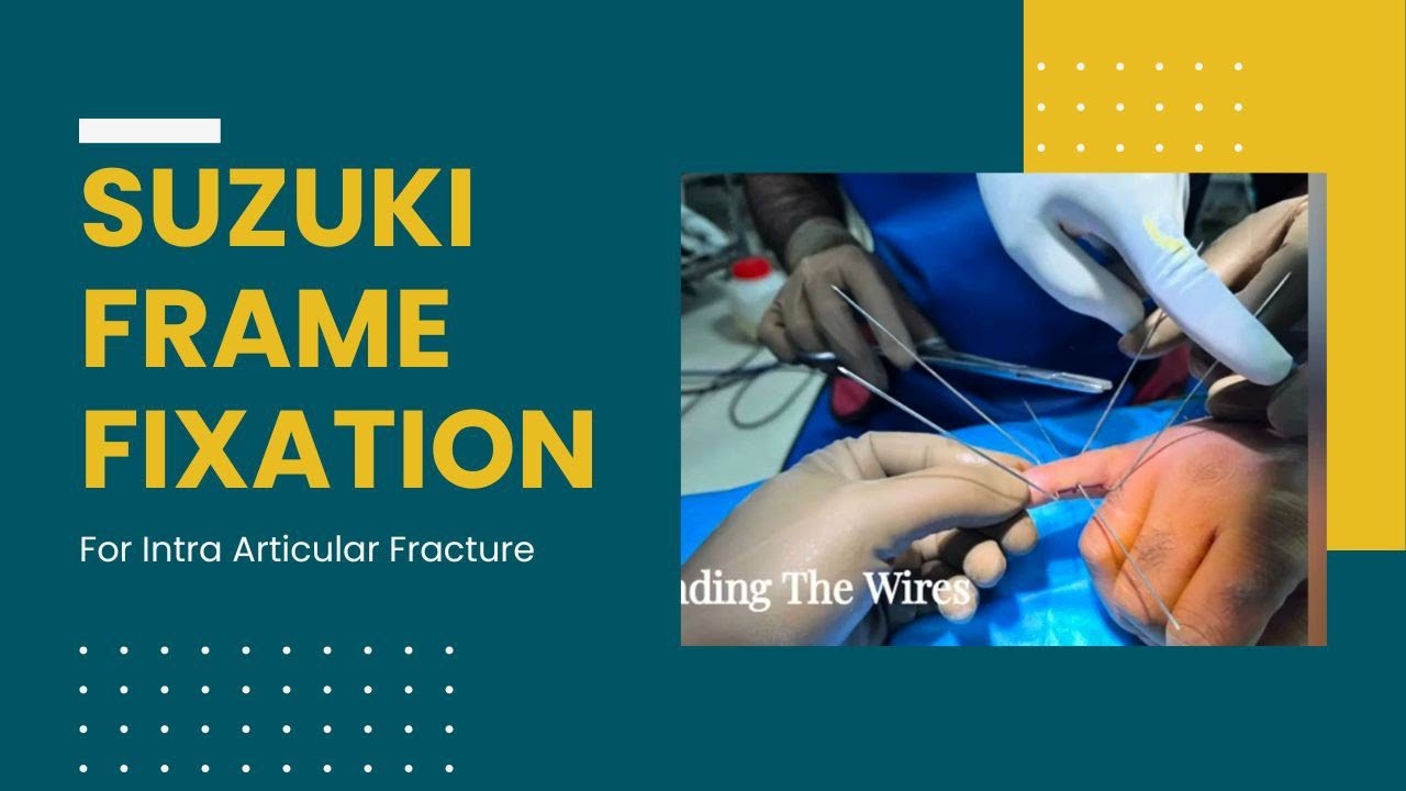 SUZUKI FRAME FIXATION FOR INTRA ARTICULAR FRACTURE MIDDLE PHALANX OF ...