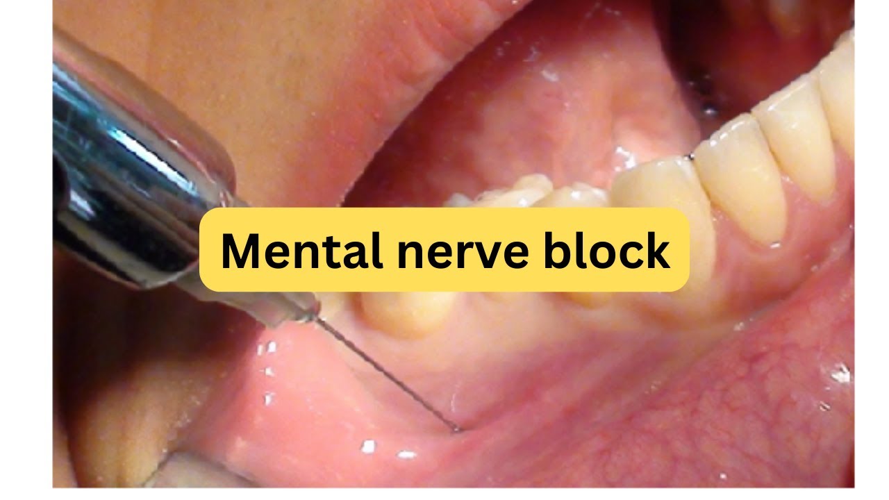 Why Would You Use A Mental Nerve Block? - YouTube