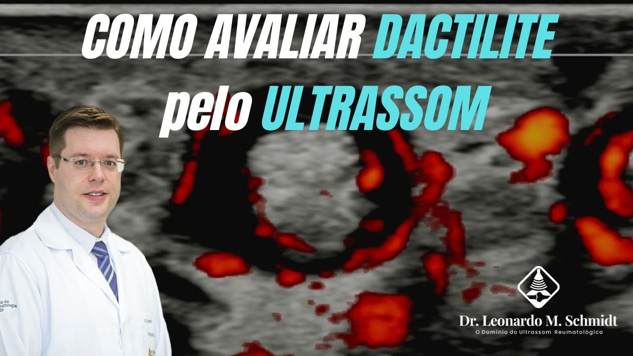 Como avaliar DACTILITE pelo ULTRASSOM? - YouTube