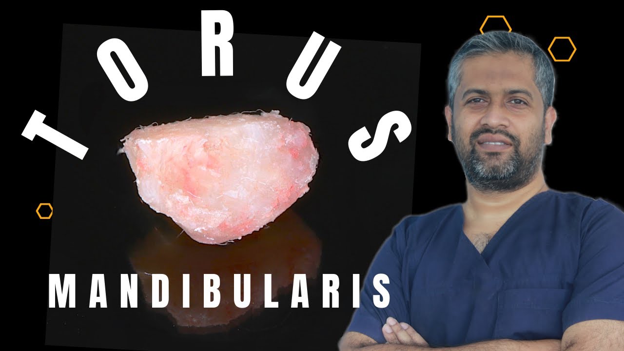 Torus Mandibularis Excision. - YouTube