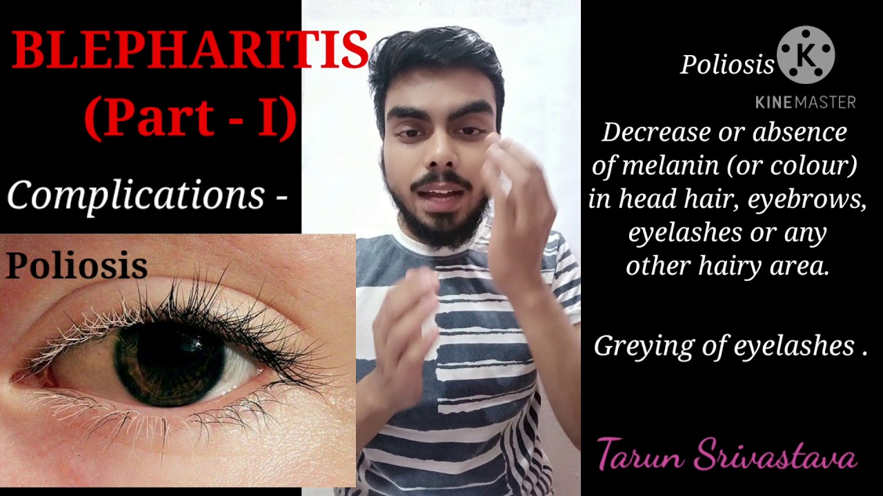 BLEPHARITIS - (1) (Inflammation of Lid margin) in easiest way with ...