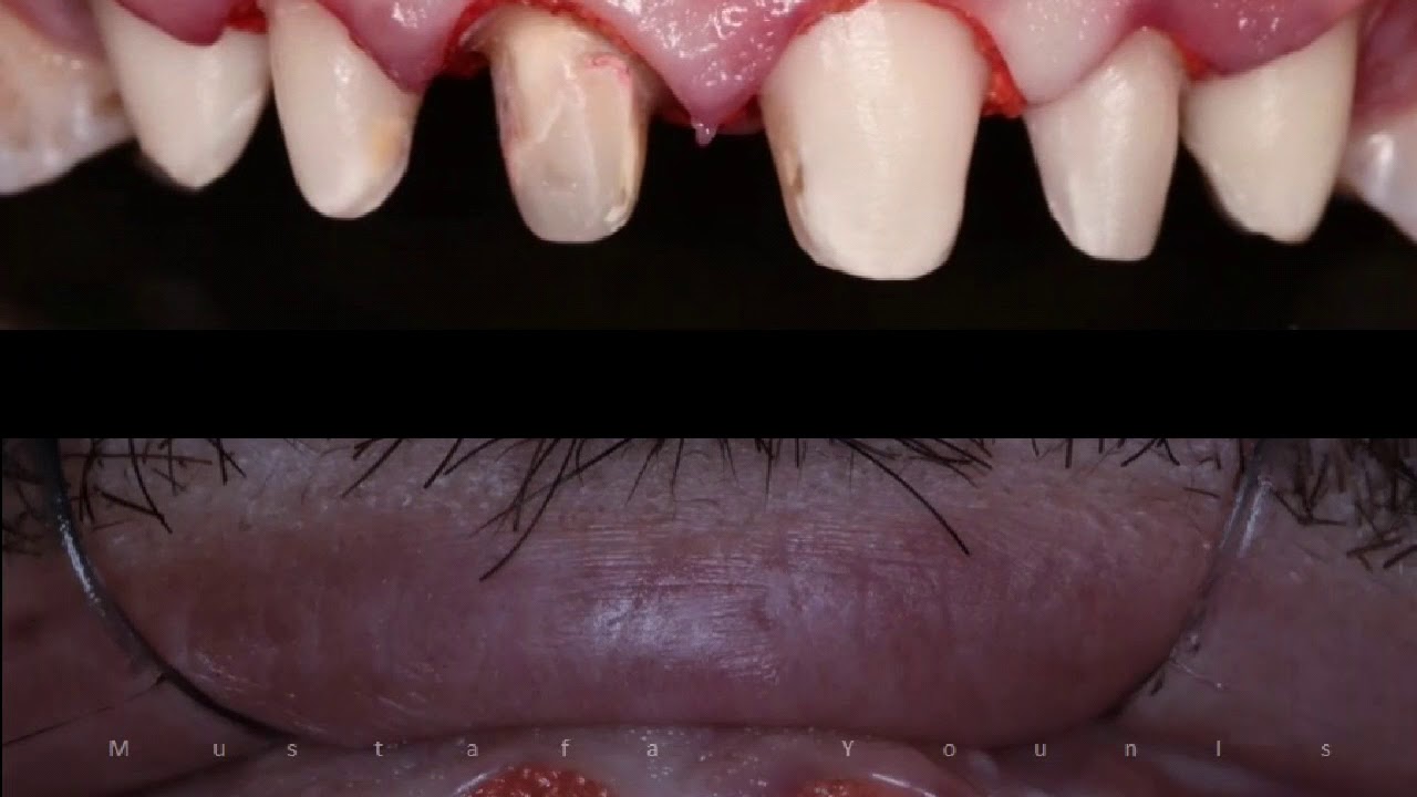 E.max Crown preparation on 6 anterior teeth - YouTube