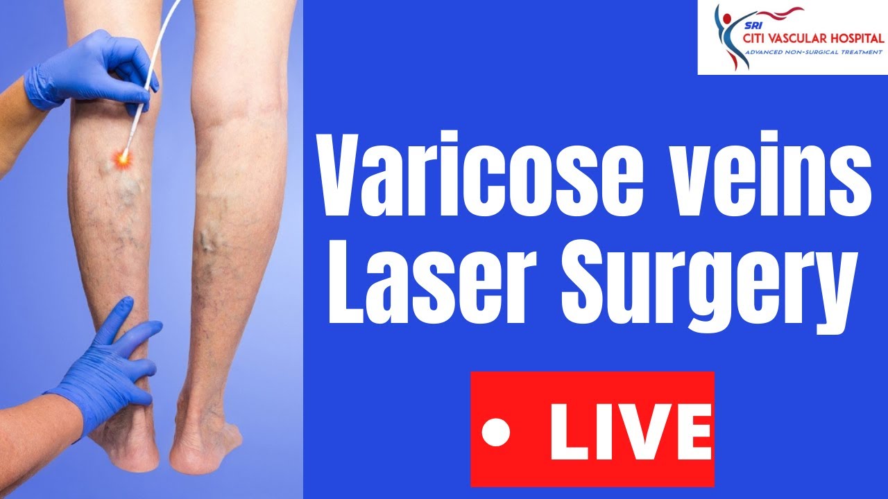 Varicose Veins Varicose Veins Laser Surgery Video In India By