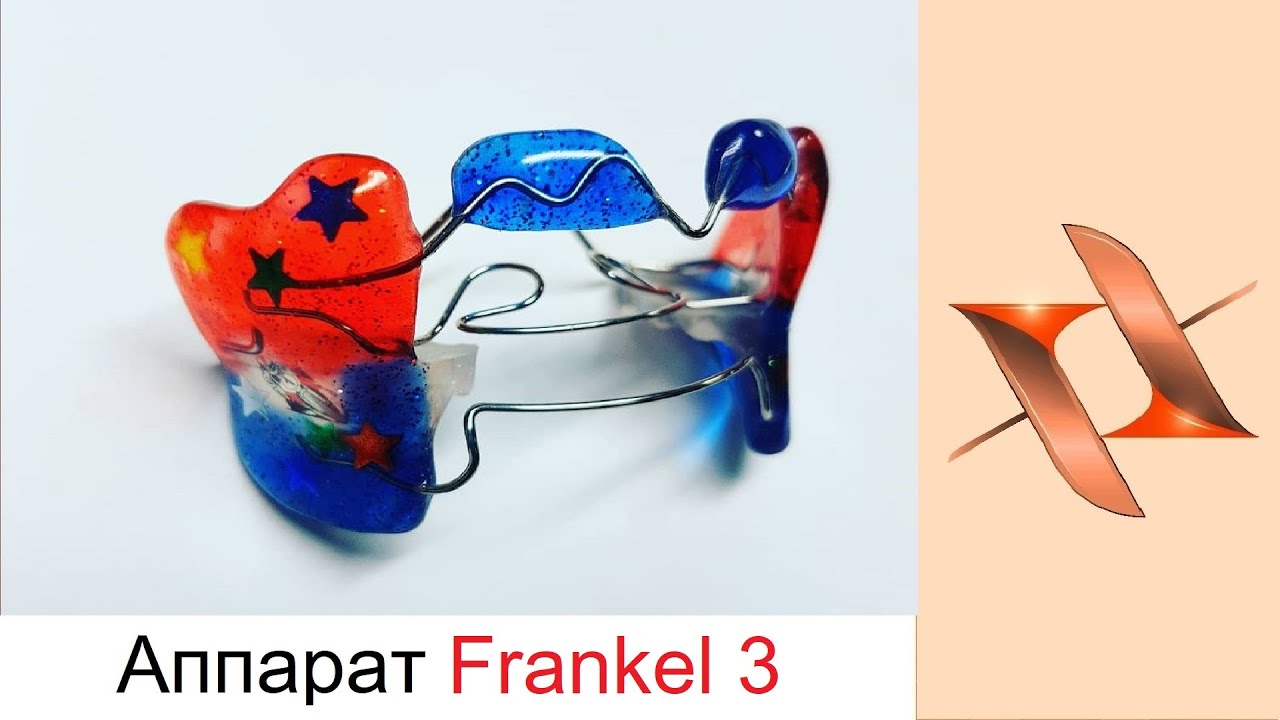 Френкель 3 (Frankel 3) - ортодонтический регулятор функций. - YouTube