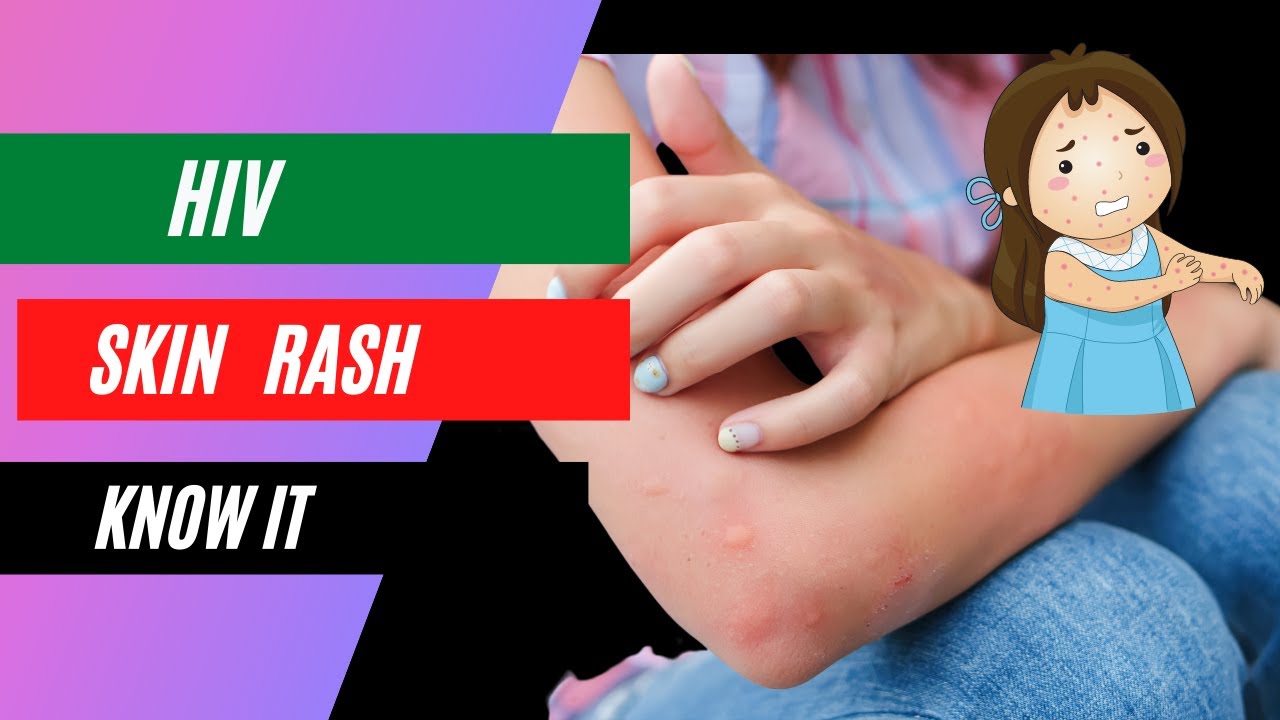 How HIV symptoms rash appear like - YouTube