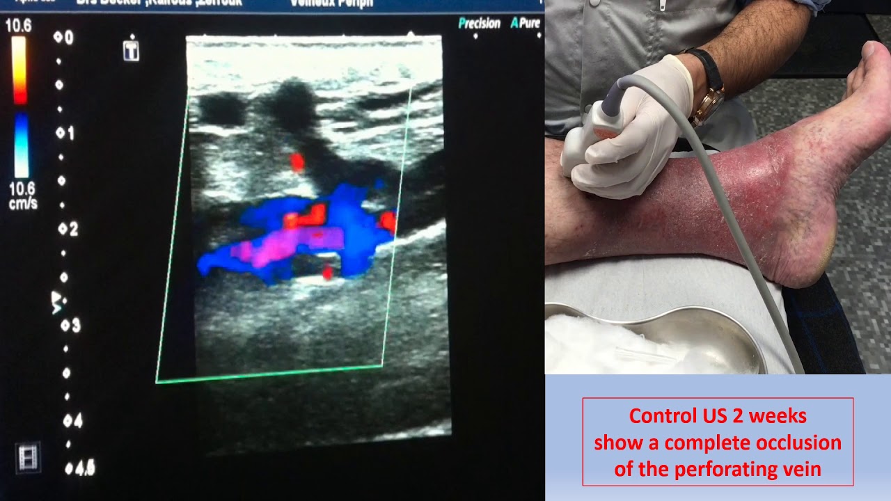 The Ultra Sound-Guided Sclerotherapy UGS of a pathologic perforating ...
