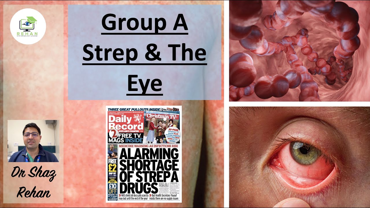 Group A Strep & How it Effects the Eye: Should I Be Worried? I Dr Shaz ...