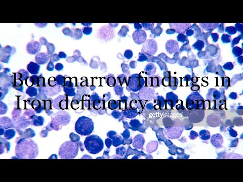 Bone marrow findings in iron deficiency anaemia - YouTube