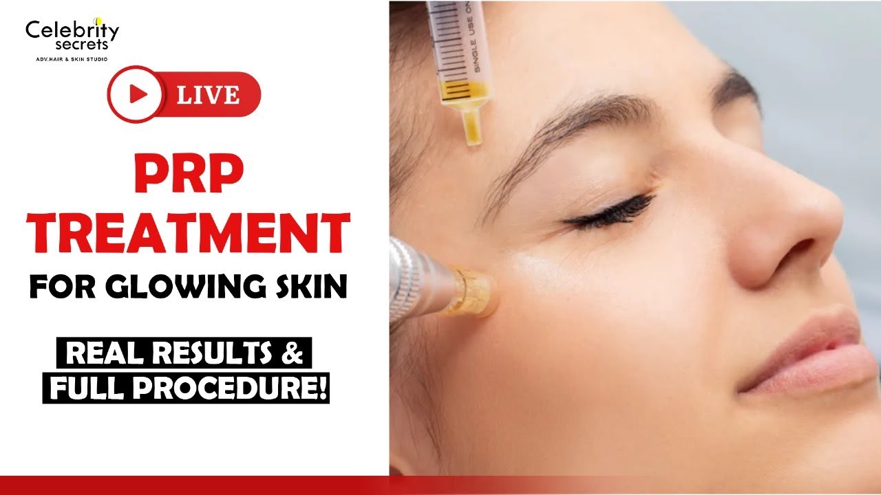 PRP Treatment for Face Benefits || PRP Procedure || PRP Treatment for ...