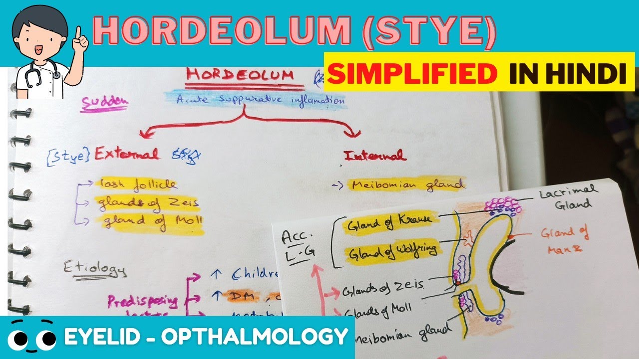 Hordeolum (Stye) | हिन्दी | Opthalmology| - YouTube