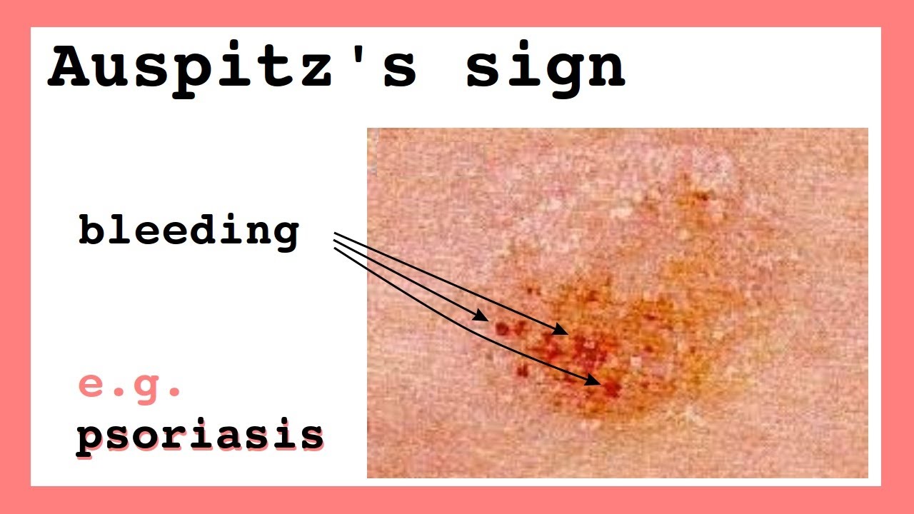 Auspitz's sign - YouTube
