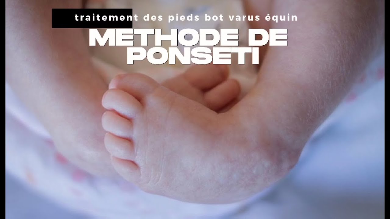 Méthode de PONSETI : traitement des pieds bots varus équins - YouTube