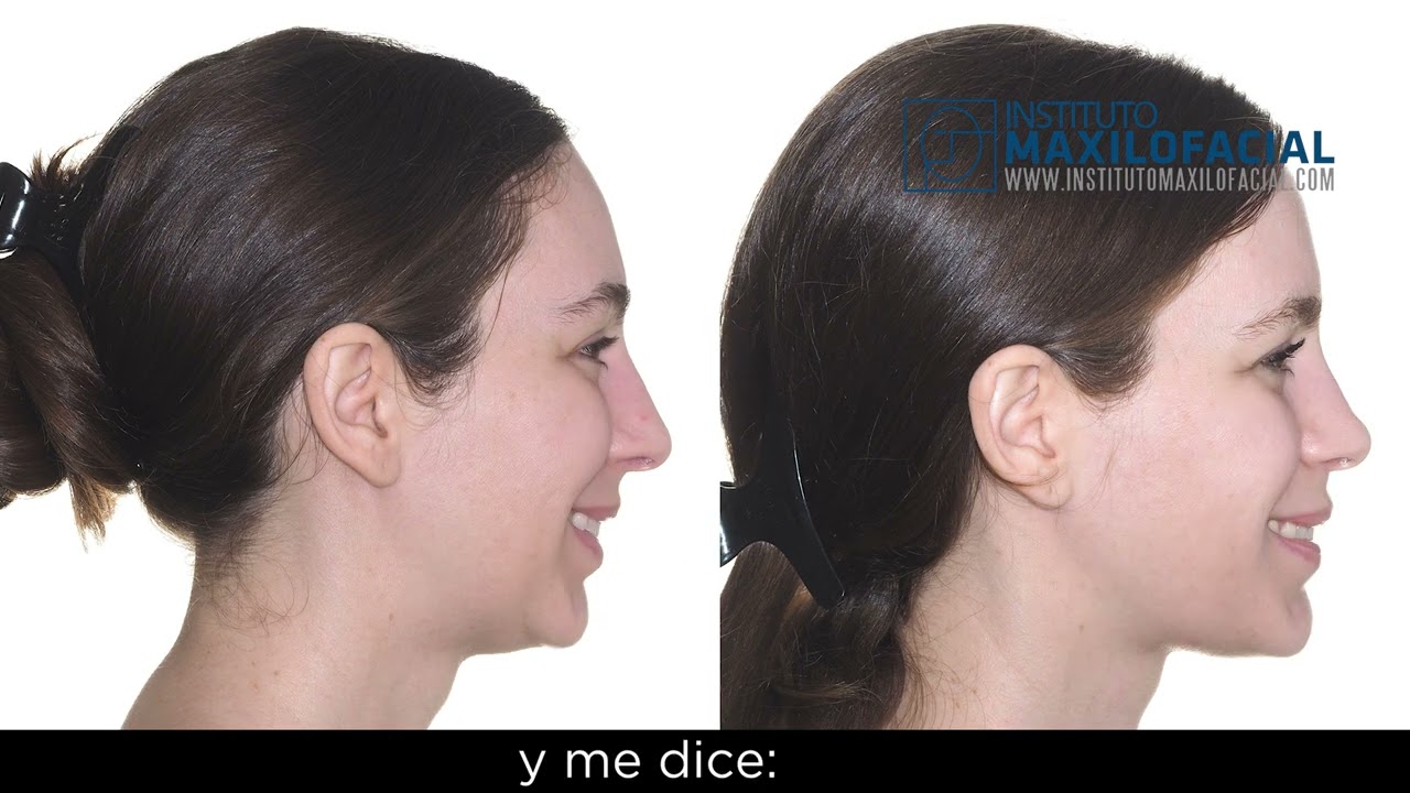 Cirugía bimaxilar Caso #107: Leanne- Retrusión maxilo-mandibular, falta ...