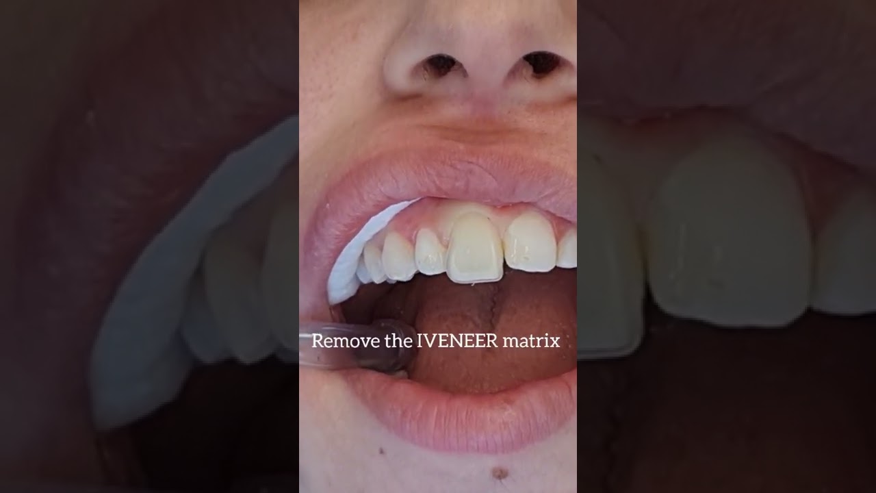 IVENEER Injectable Matrix system tooth no.11 - Live - YouTube