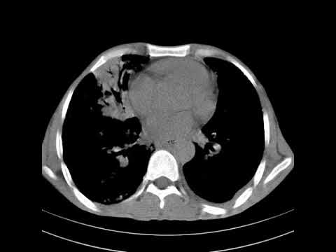 CT Chest Non Contrast 02 - YouTube