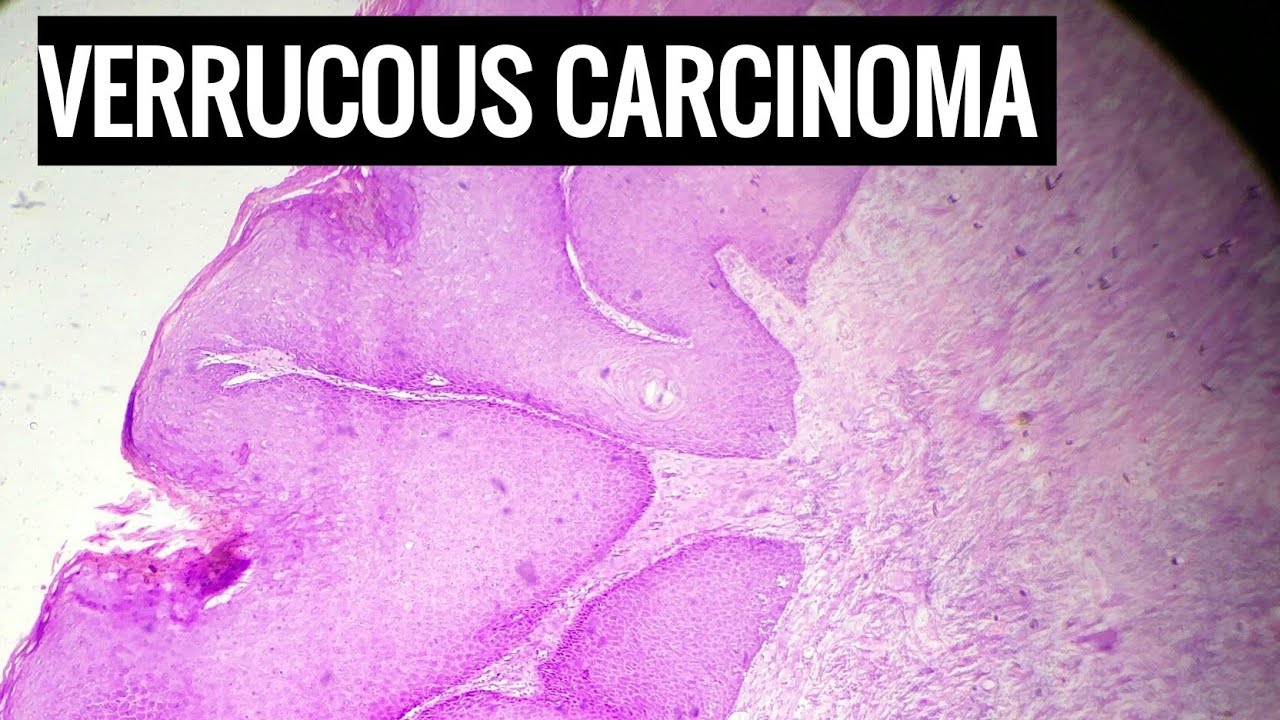 Verrucous Carcinoma Histopathology - YouTube