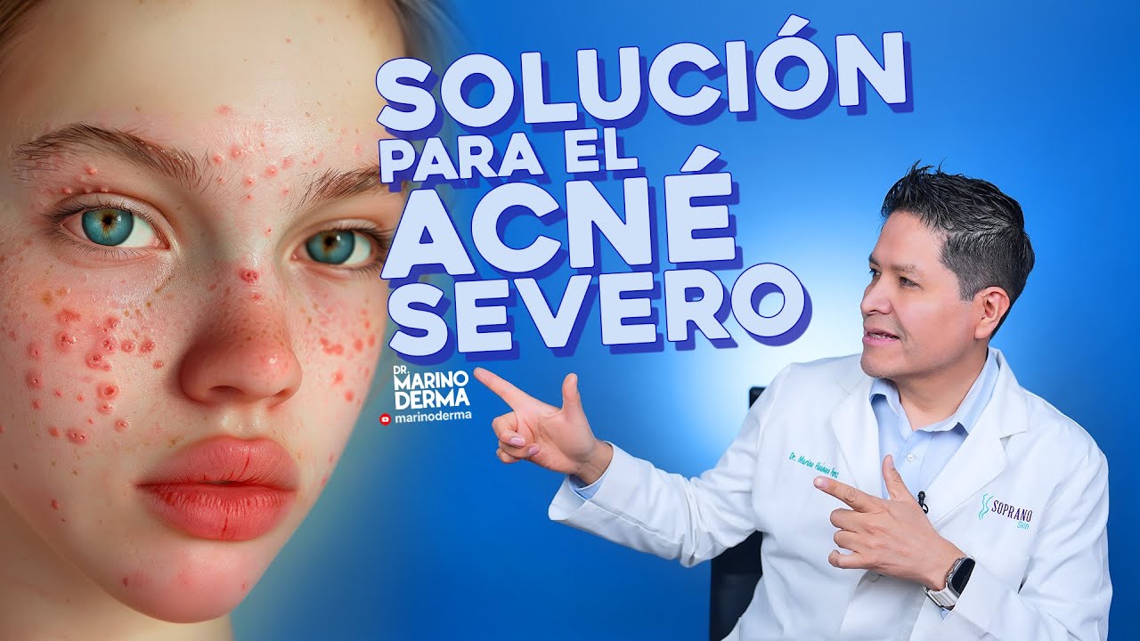 SOLUCIÓN PARA EL ACNÉ SEVERO || Consejos de un dermatólogo - YouTube