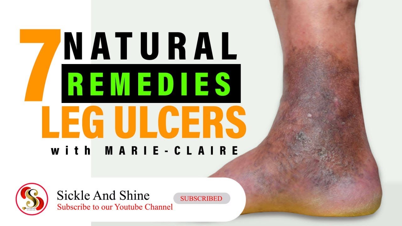 Leg Ulcer Remedies - YouTube