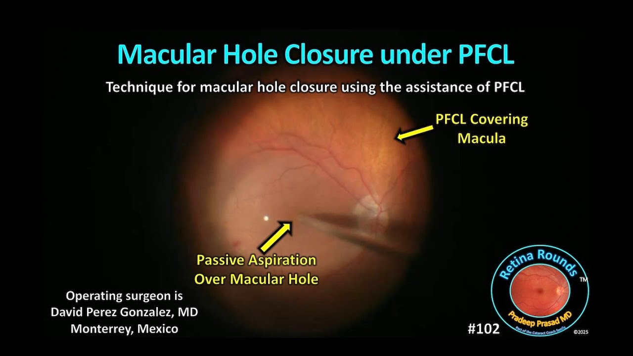 RetinaRounds™ 102: Macular Hole Closure Under PFCL - YouTube