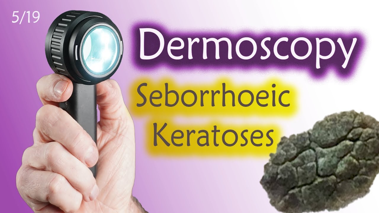 Are Seborrhoeic Keratoses [Seb K] the Chameleon of Primary Care ...
