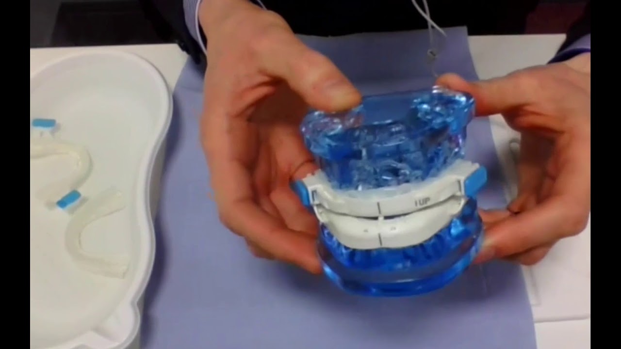 BluePro Webinar raising the bar in transitional appliance therapy with ...