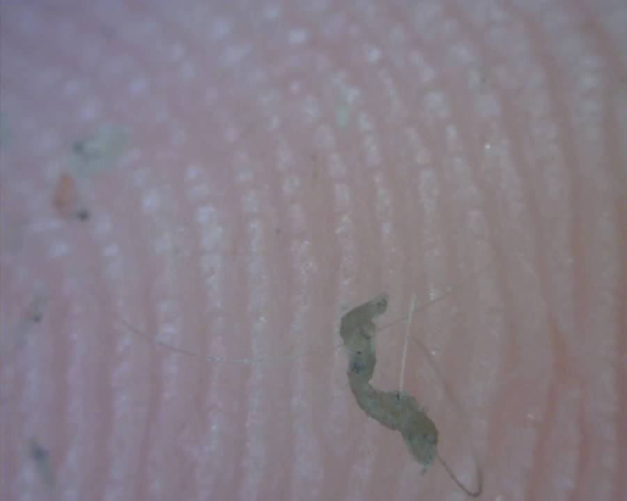 the cause of morgellons painful bites - YouTube