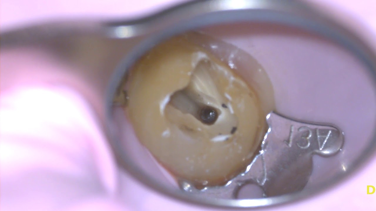 broken file retrieval from apical third of the palatal of upper 2nd ...