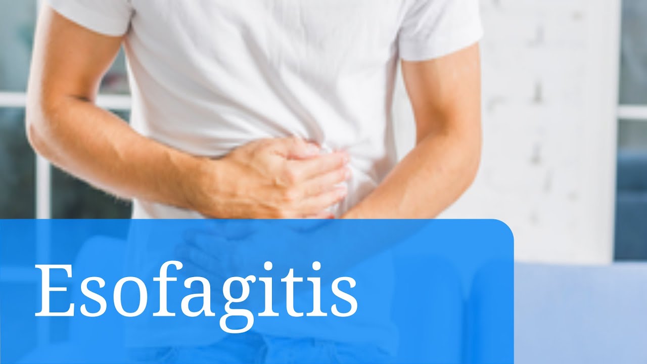 Esofagitis. Qué es, qué la causa y cómo se trata - YouTube