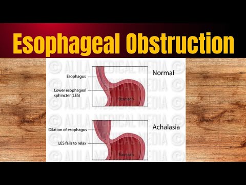 Lecture #9 Esophageal Obstruction 🔥||GI Pathology||Best Medical Channel ...